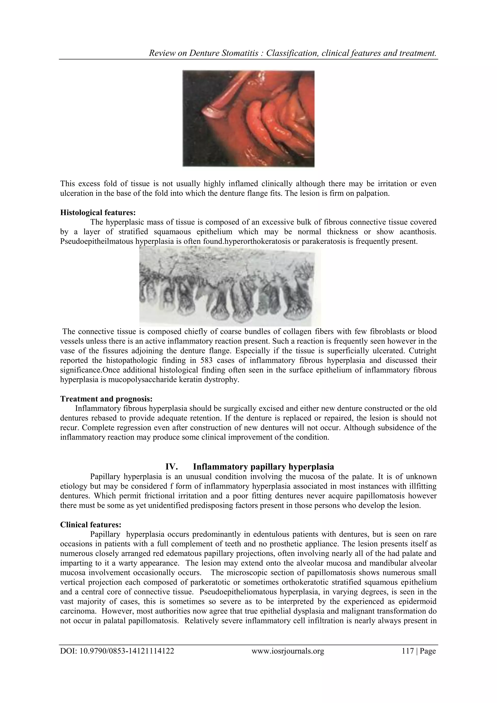 Review on Denture Stomatitis : Classification, clinical features and ...