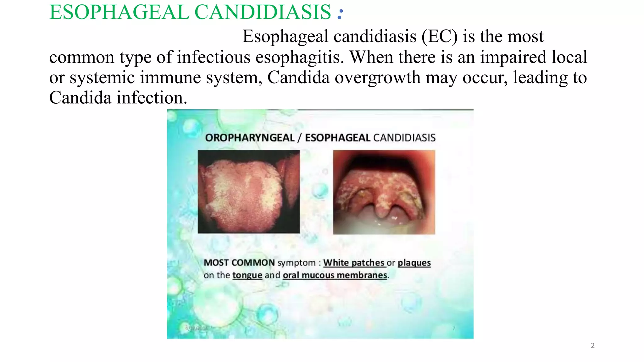 case presentation on esophageal candidiasis & varices | PPTX