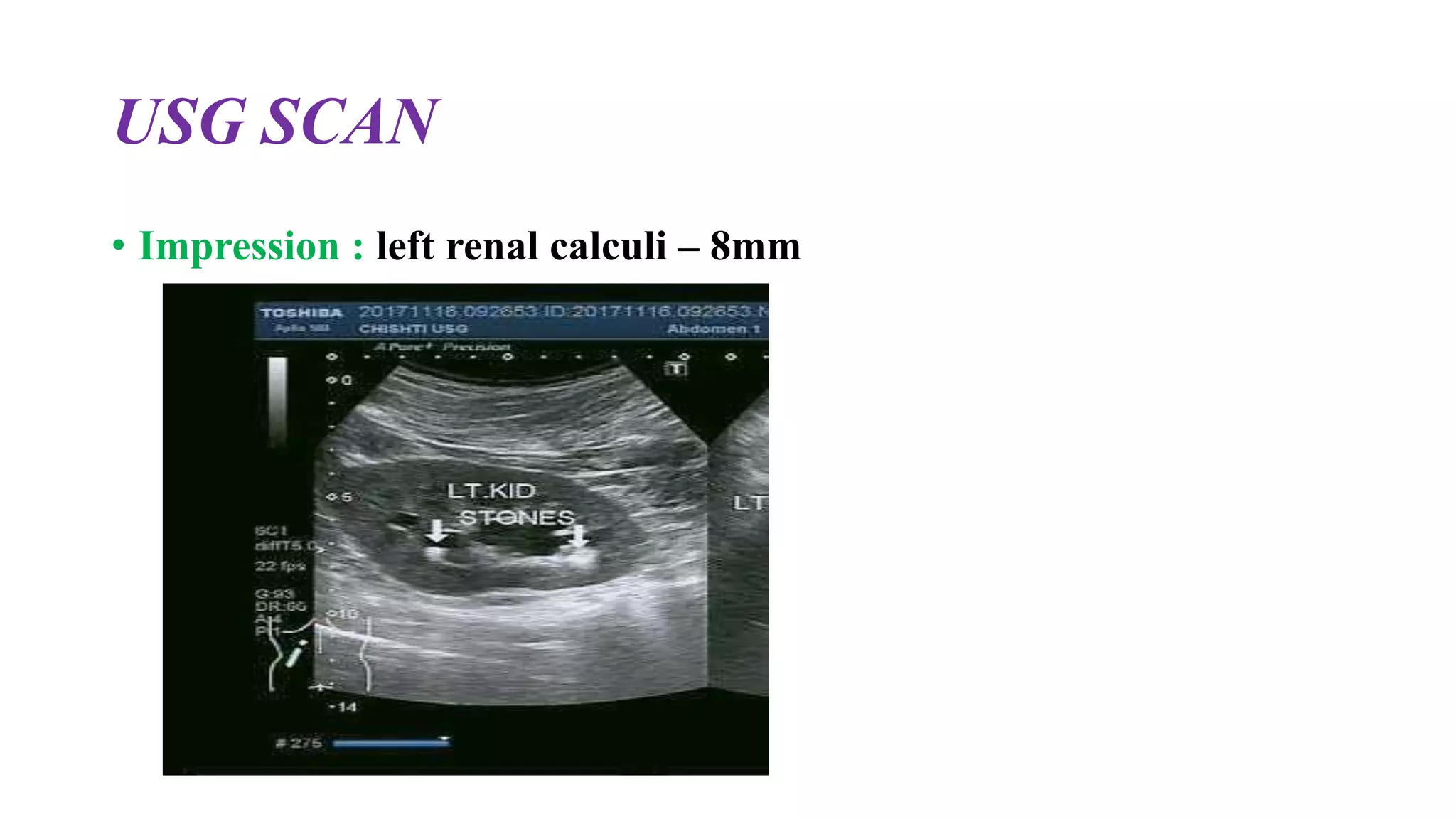 Renal calculi | PPTX