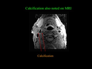 120 mr imaging for the evaluation of carotid atherosclerosis | PPT
