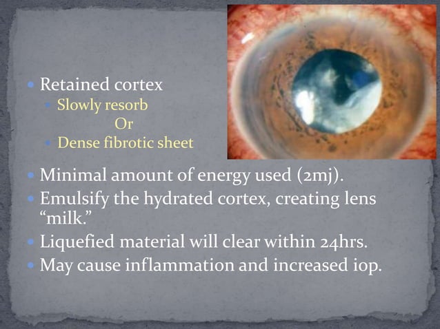 Yag capsulotomy | PPTX