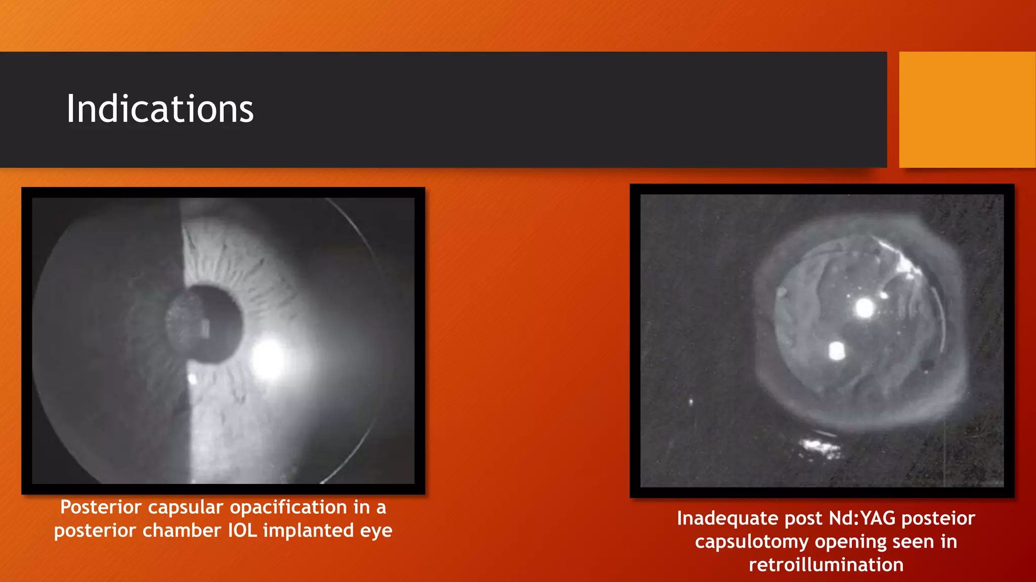 Yag post capsulotomy | PPTX