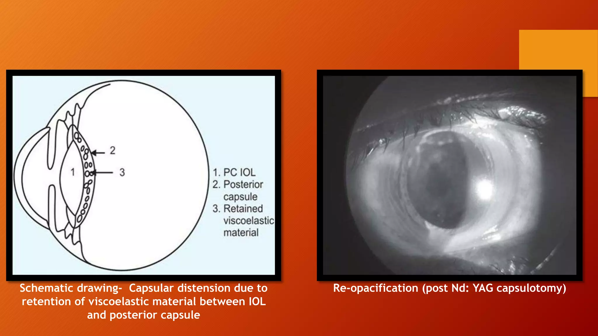 Yag post capsulotomy | PPTX