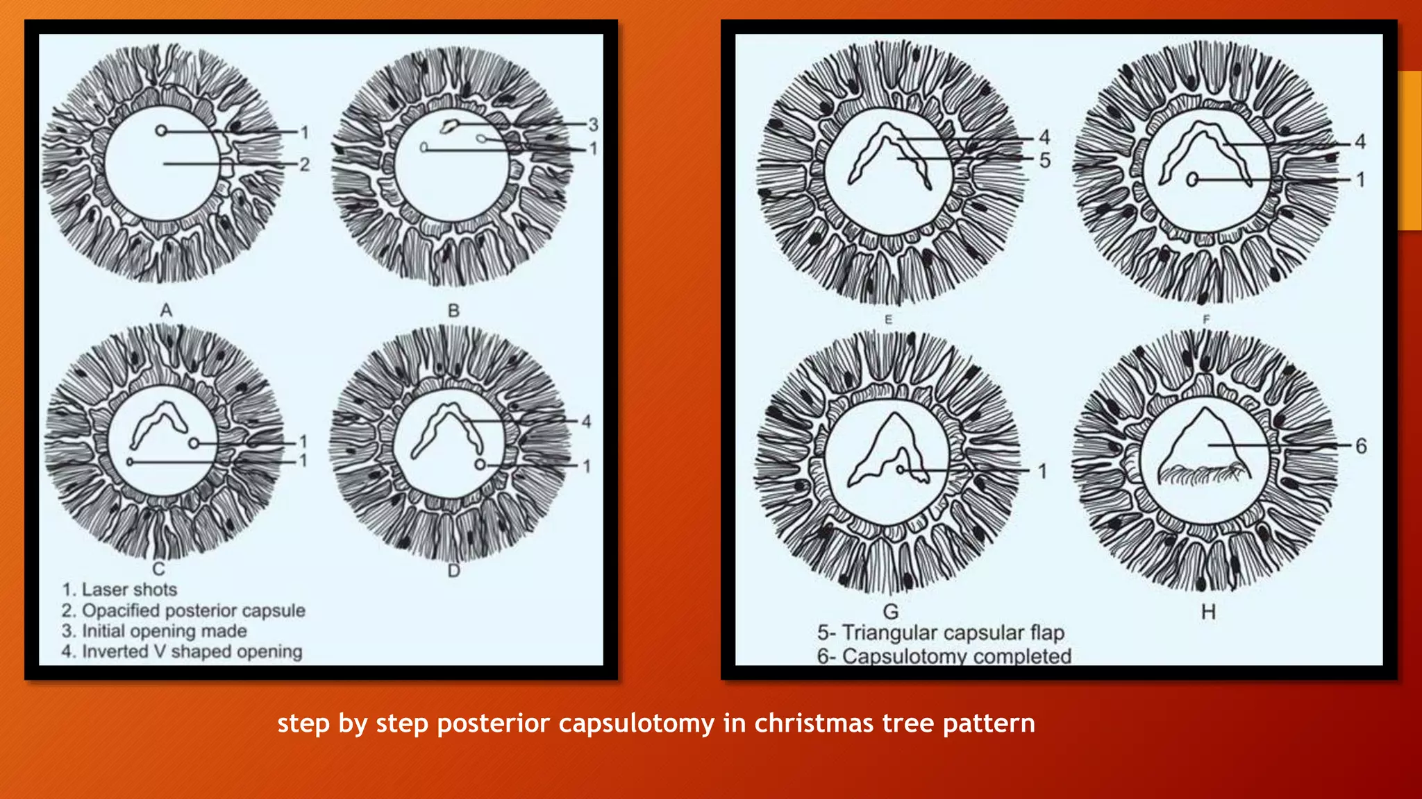Yag post capsulotomy | PPTX