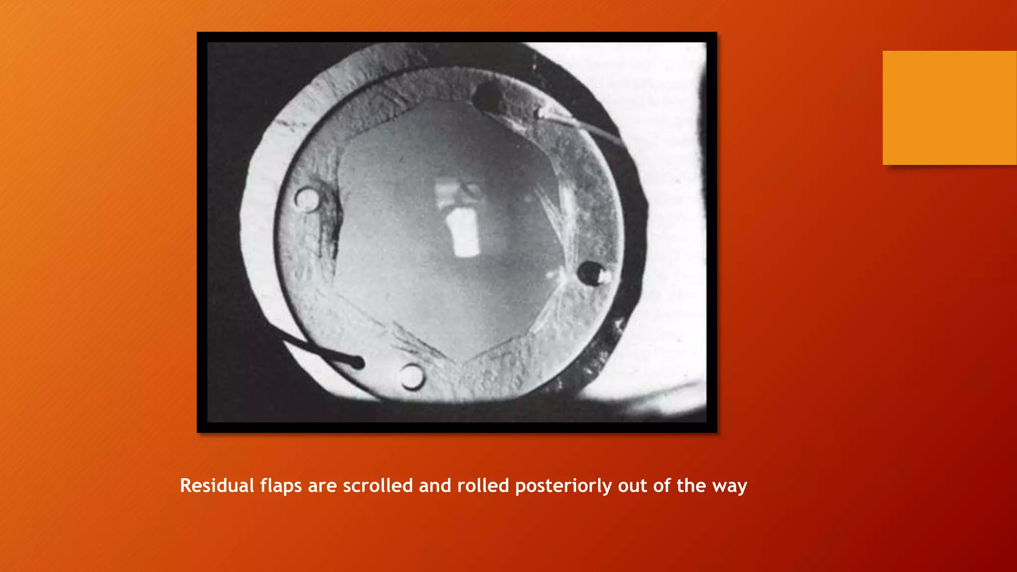 Yag post capsulotomy | PPTX