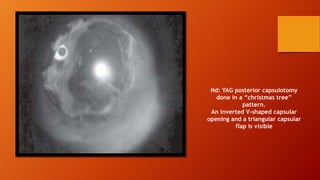 Yag post capsulotomy | PPTX
