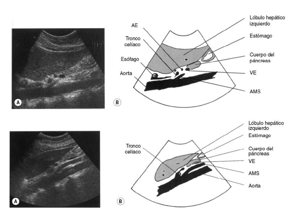 Ecografía normal de hígado y Ecografía Doppler de Vasos Hepáticos