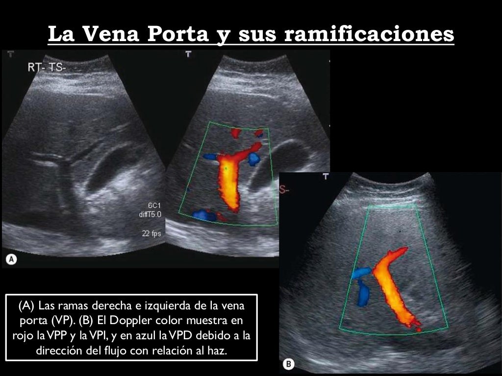 Ecografía normal de hígado y Ecografía Doppler de Vasos Hepáticos