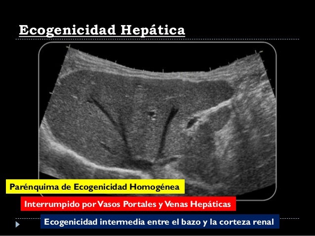Ecografía normal de hígado y Ecografía Doppler de Vasos Hepáticos