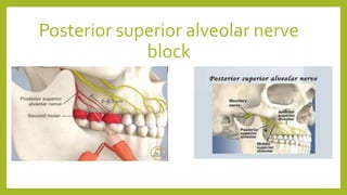 yash_1_.pptx nerve blocks maxillary psa | PPTX