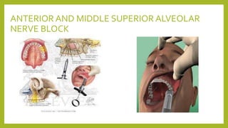 yash_1_.pptx nerve blocks maxillary psa | PPTX