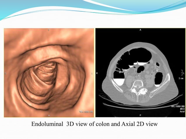 Imaging of Large Bowel Polyp | PPTX | Digestive Disorders | Diseases ...