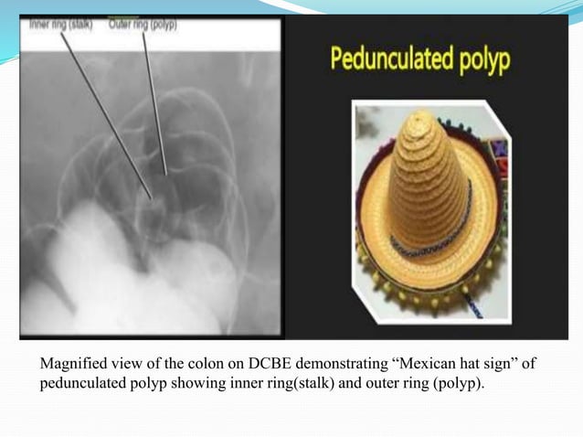 Imaging of Large Bowel Polyp | PPTX | Digestive Disorders | Diseases ...