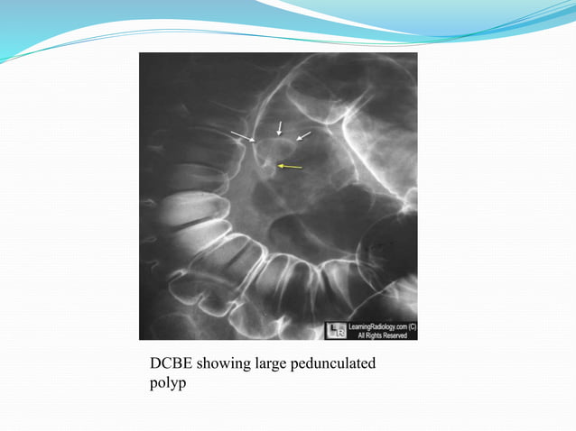 Imaging of Large Bowel Polyp | PPTX | Digestive Disorders | Diseases ...