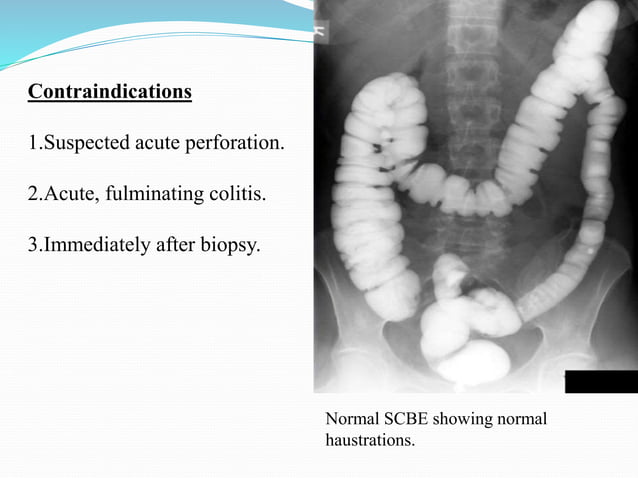 Imaging of Large Bowel Polyp | PPTX | Digestive Disorders | Diseases ...