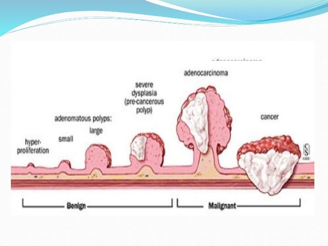 Imaging of Large Bowel Polyp
