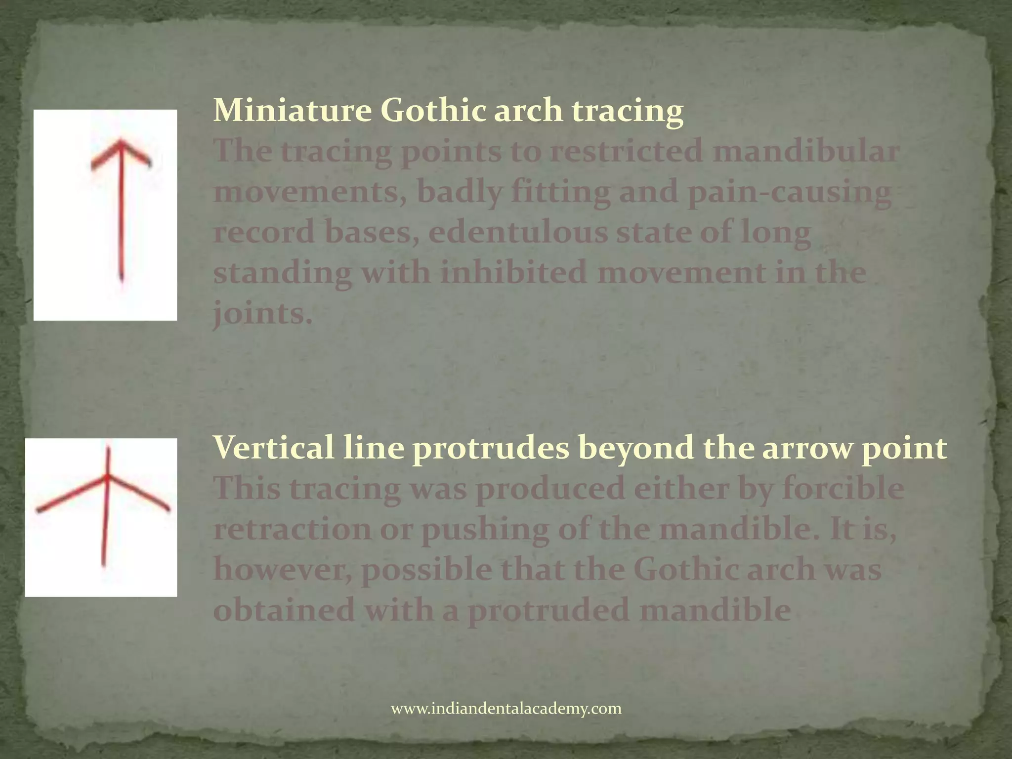 Gothic arch tracers | PPTX
