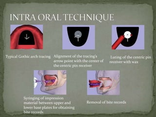 Gothic arch tracers | PPTX