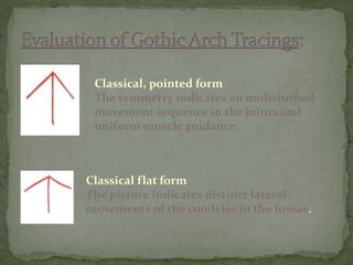 Gothic arch tracers | PPTX