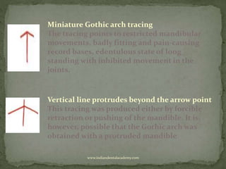 Gothic arch tracers | PPTX