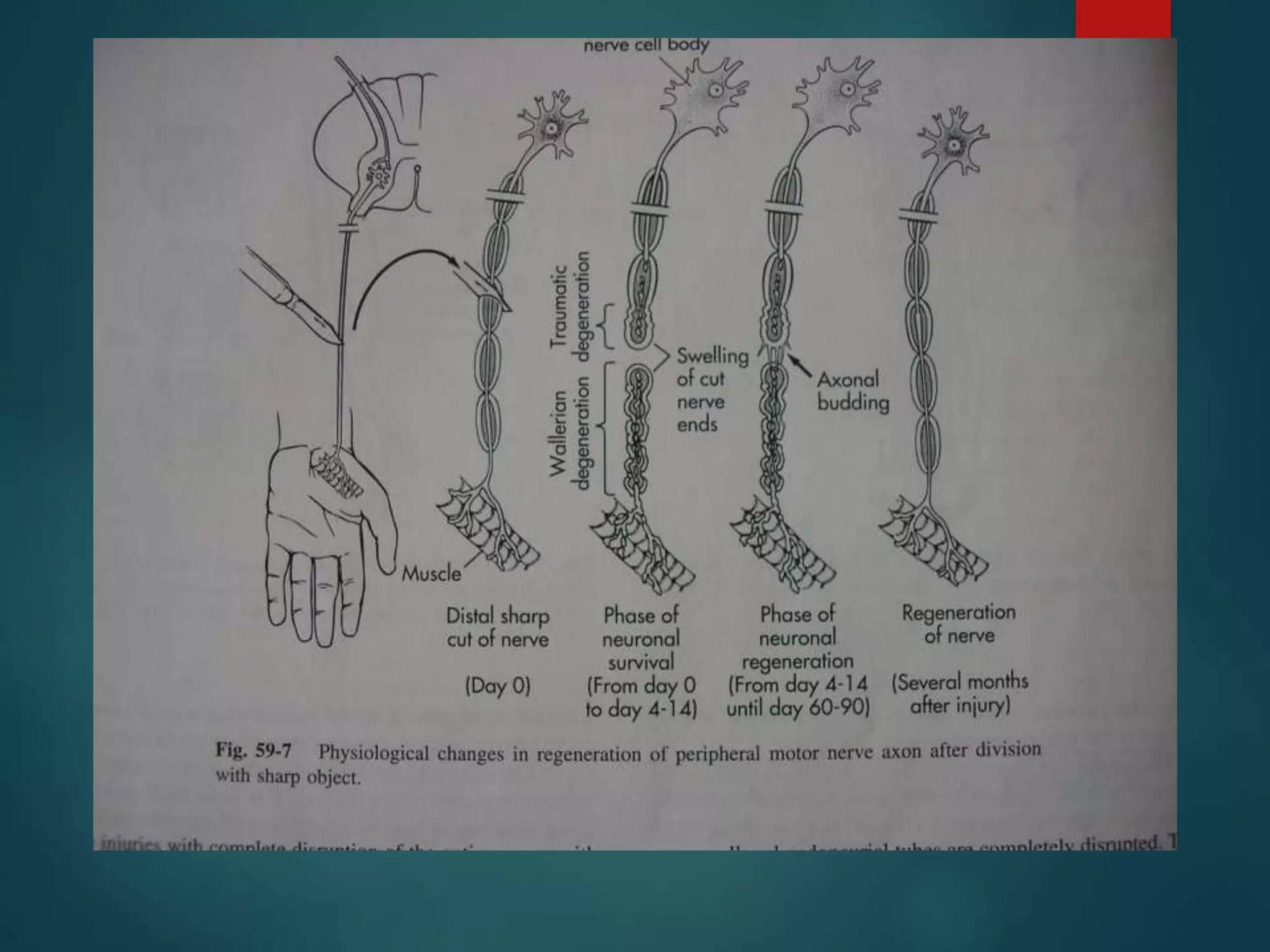 peripheral nerve injury concepts and management | PPTX