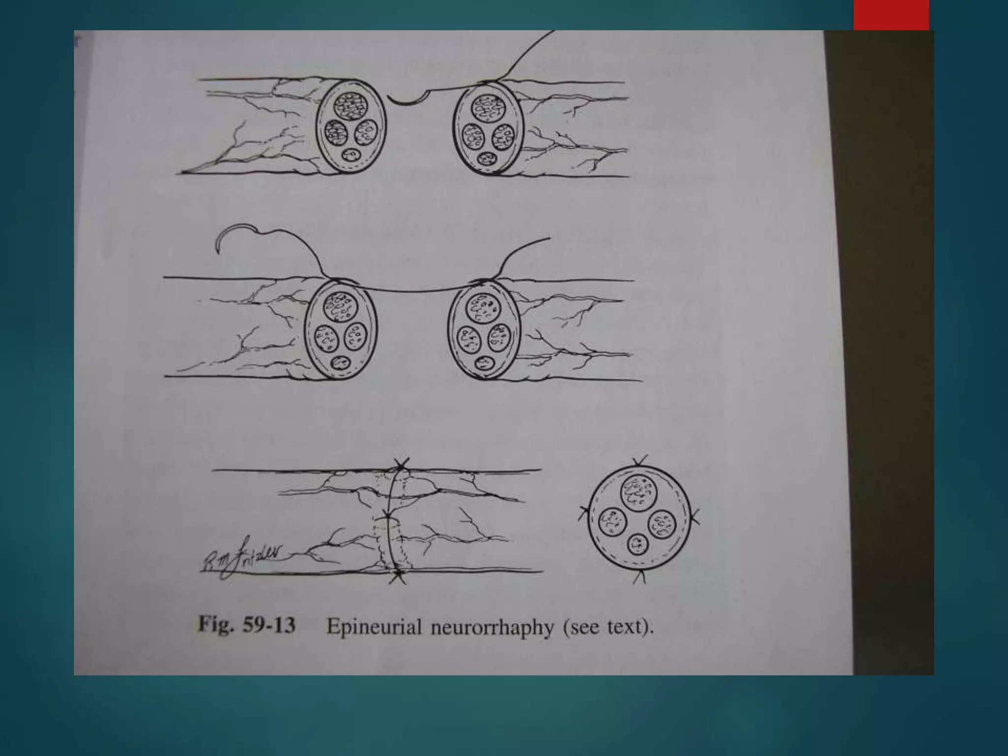 peripheral nerve injury concepts and management | PPTX