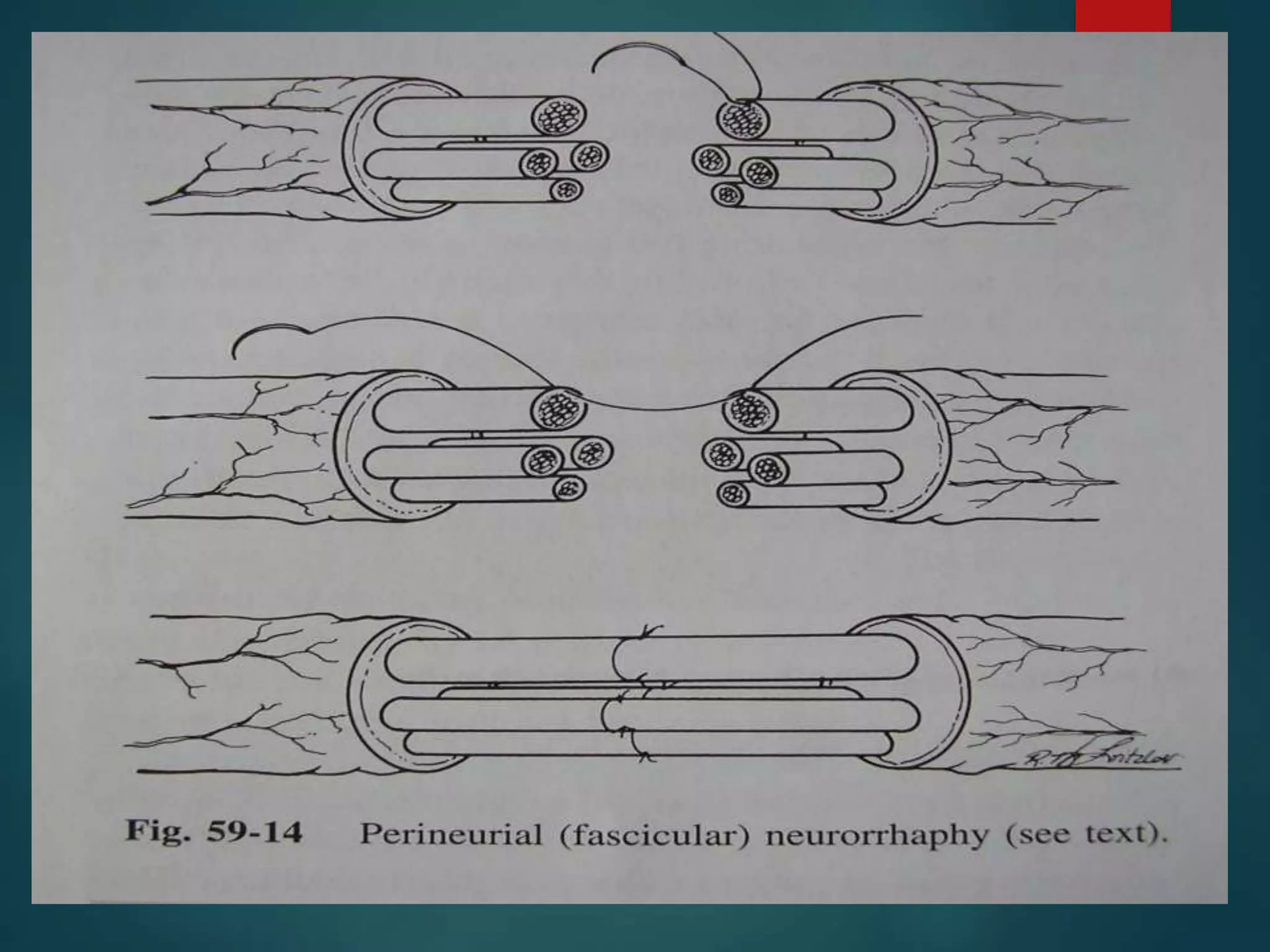 peripheral nerve injury concepts and management | PPTX