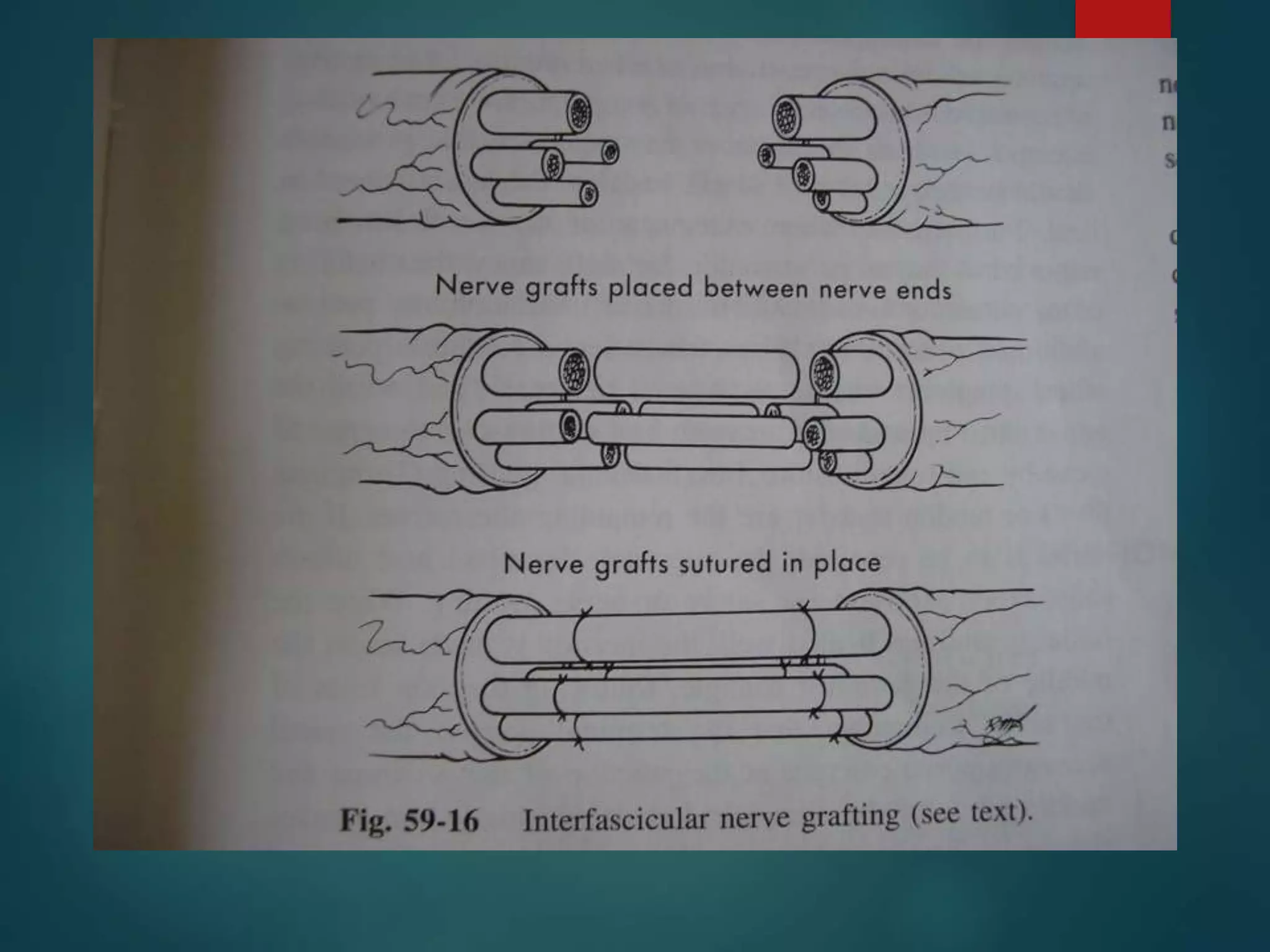 peripheral nerve injury concepts and management | PPTX