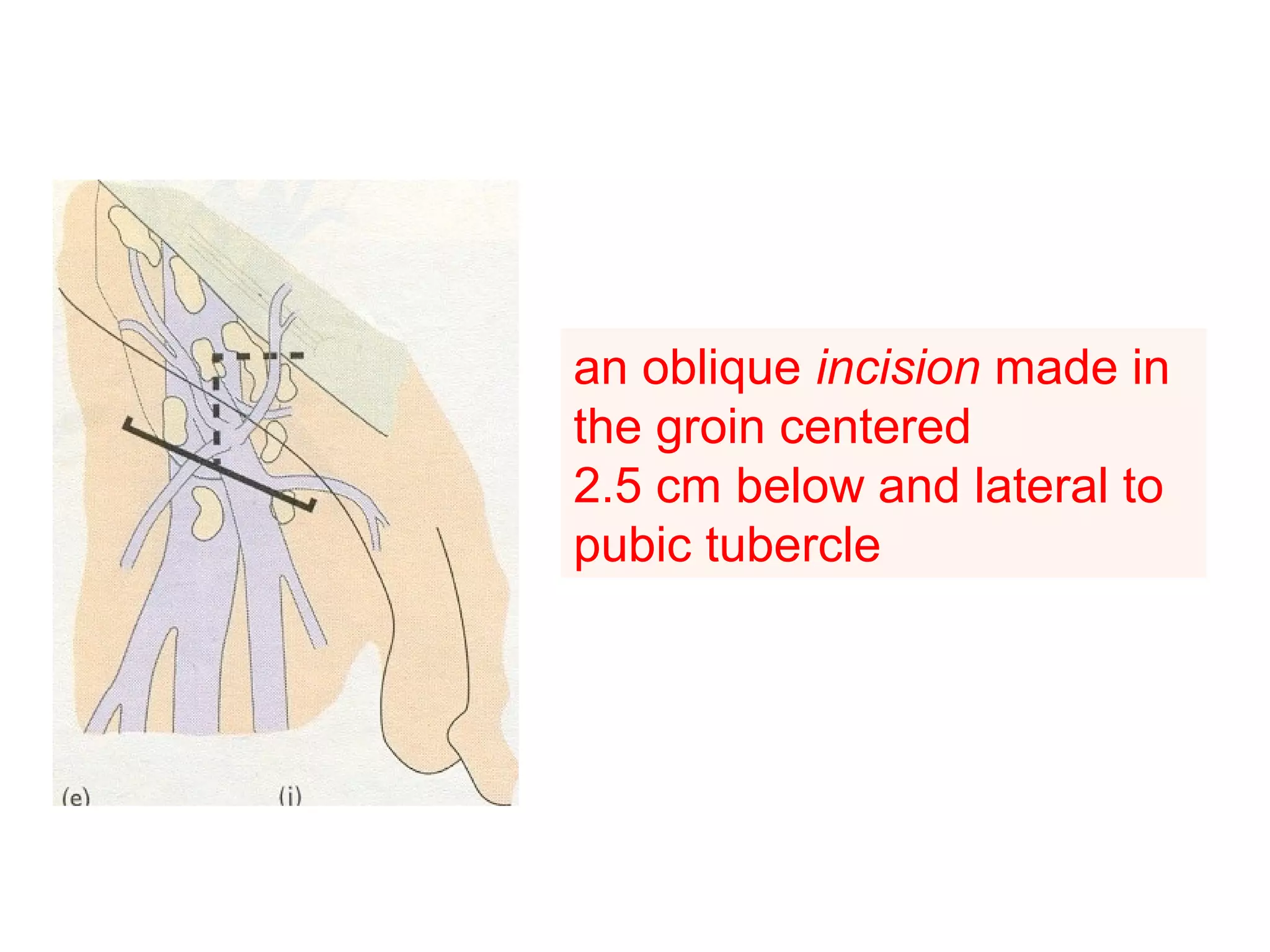 varicose vein surgery | PPT