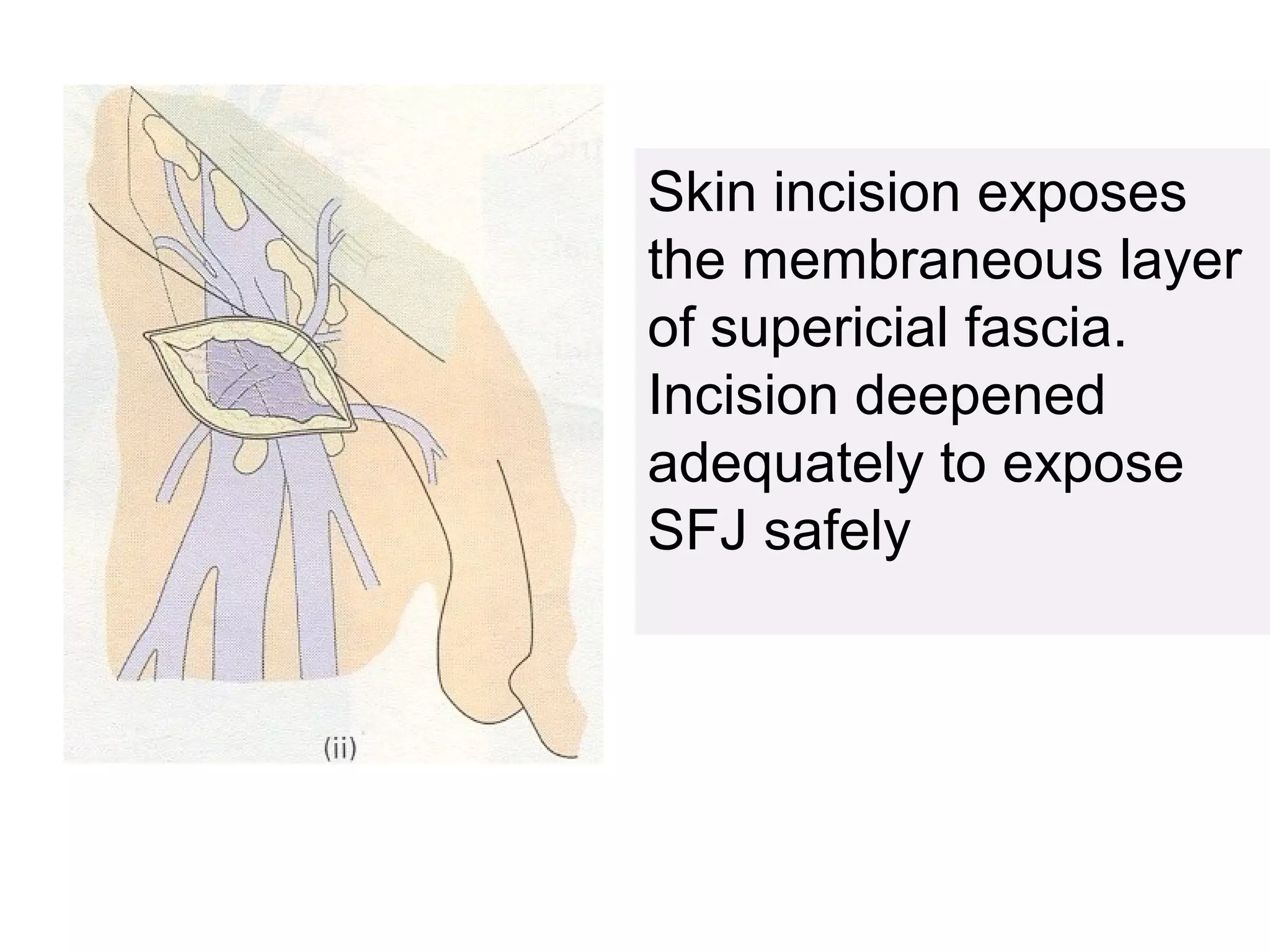 varicose vein surgery | PPT