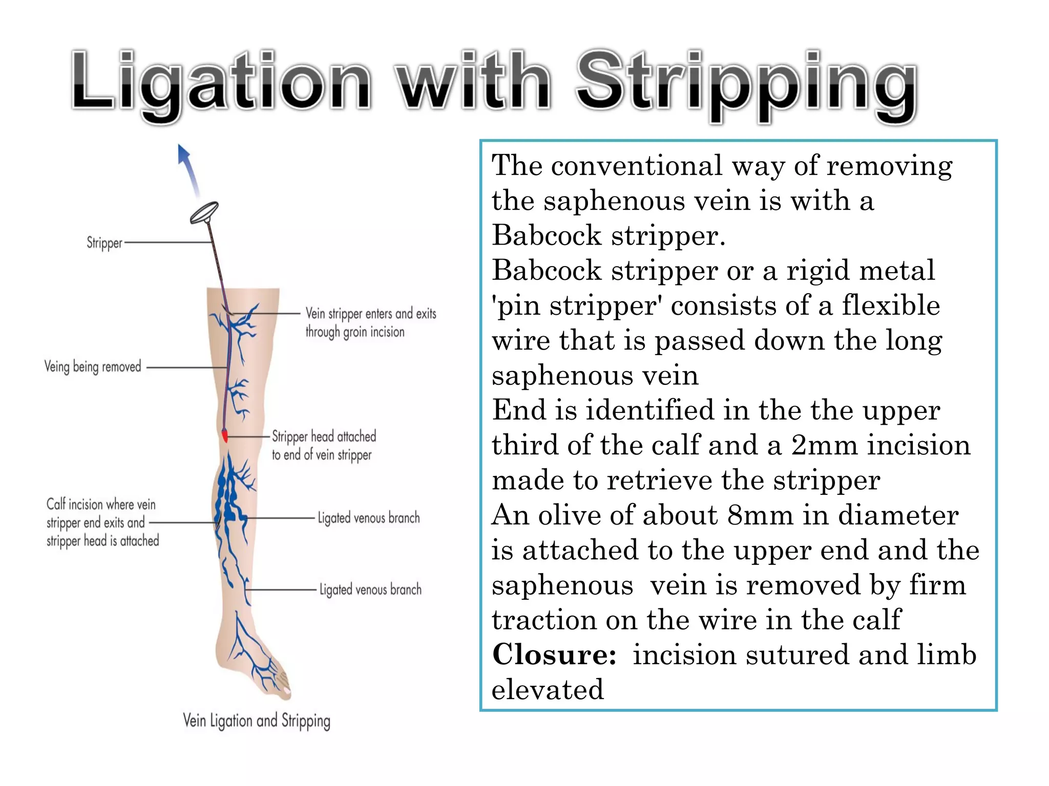 varicose vein surgery | PPT