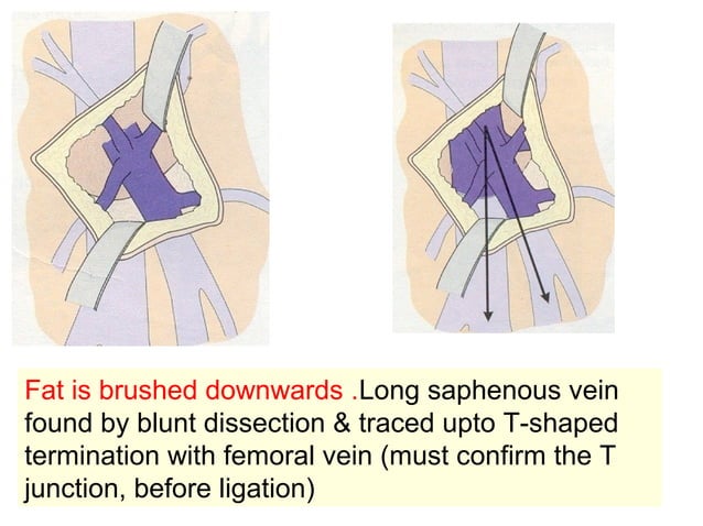 varicose vein surgery | PPT