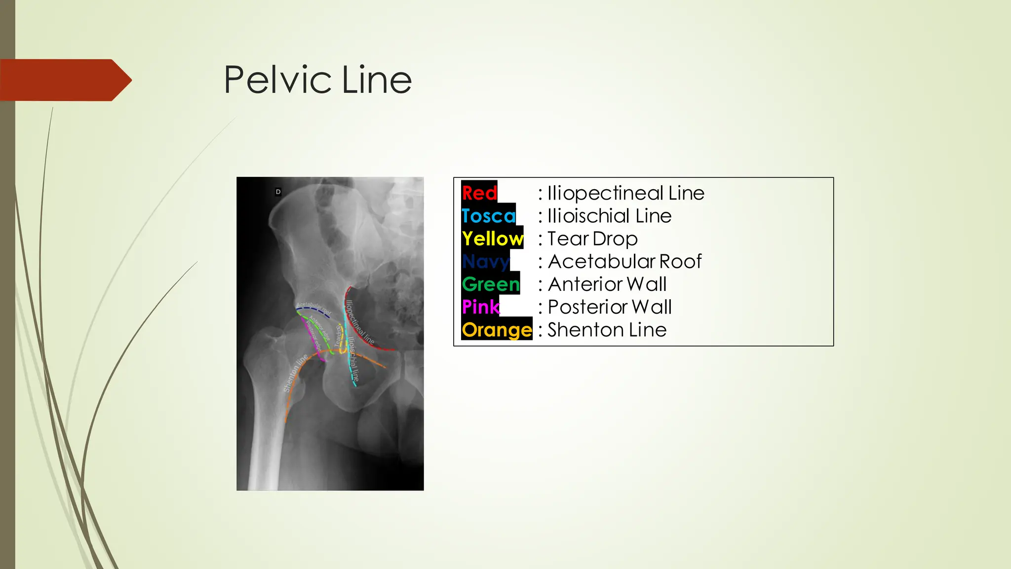Young Burgess Classification PELVIC KAM.pdf