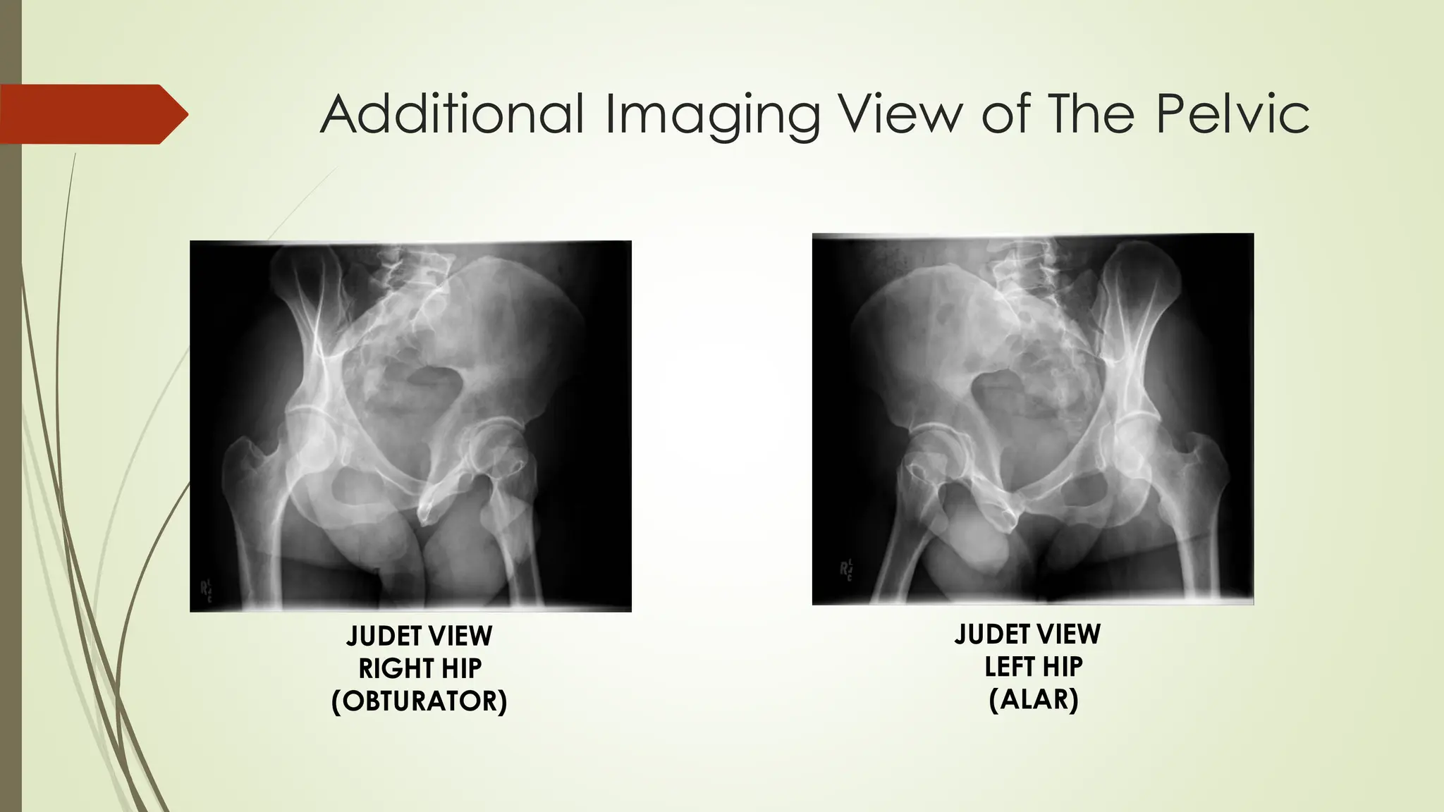 Young Burgess Classification PELVIC KAM.pdf