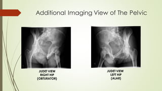 Young Burgess Classification PELVIC KAM.pdf