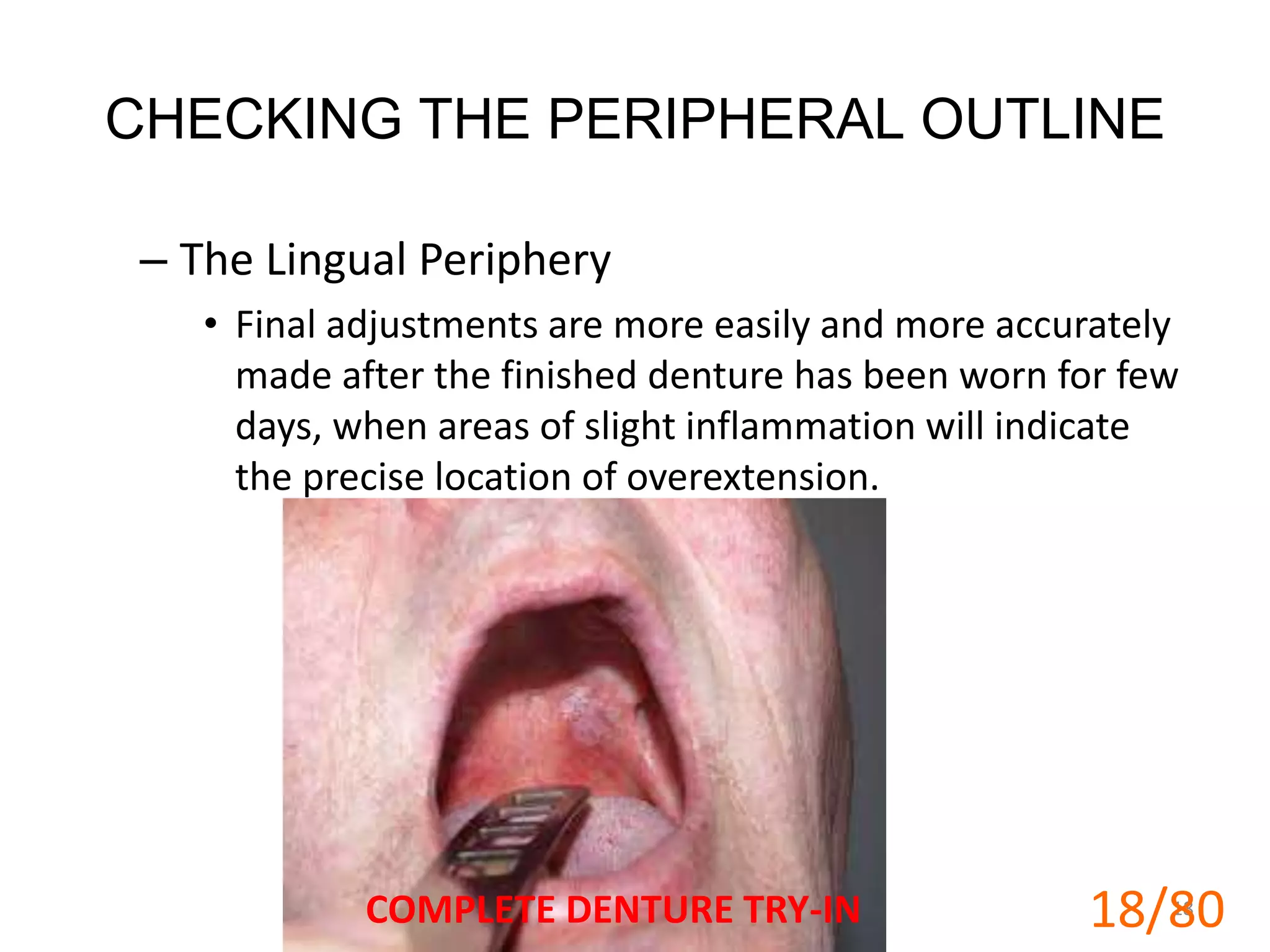 Complete Denture Try In | PPTX