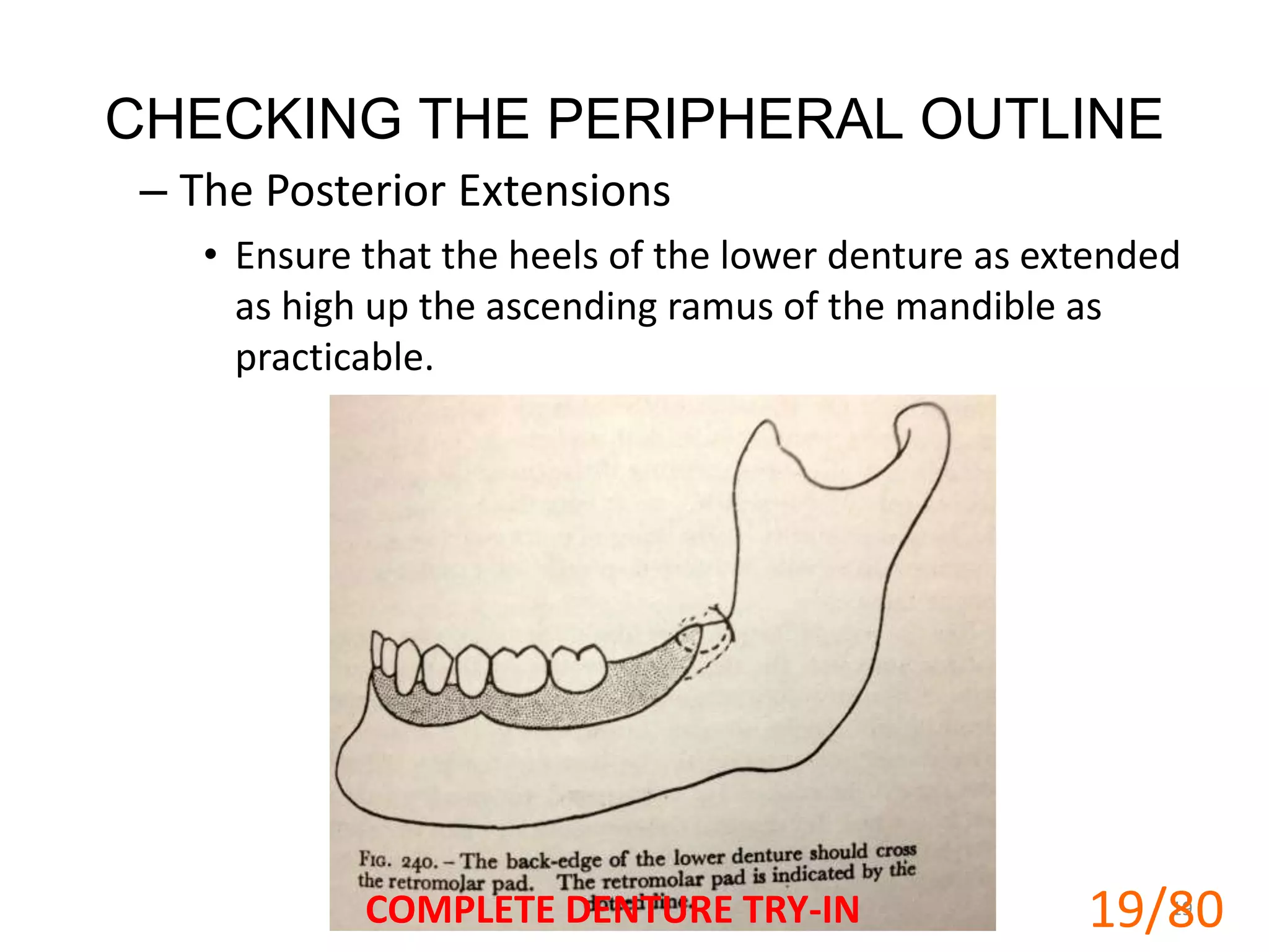 Complete Denture Try In | PPTX