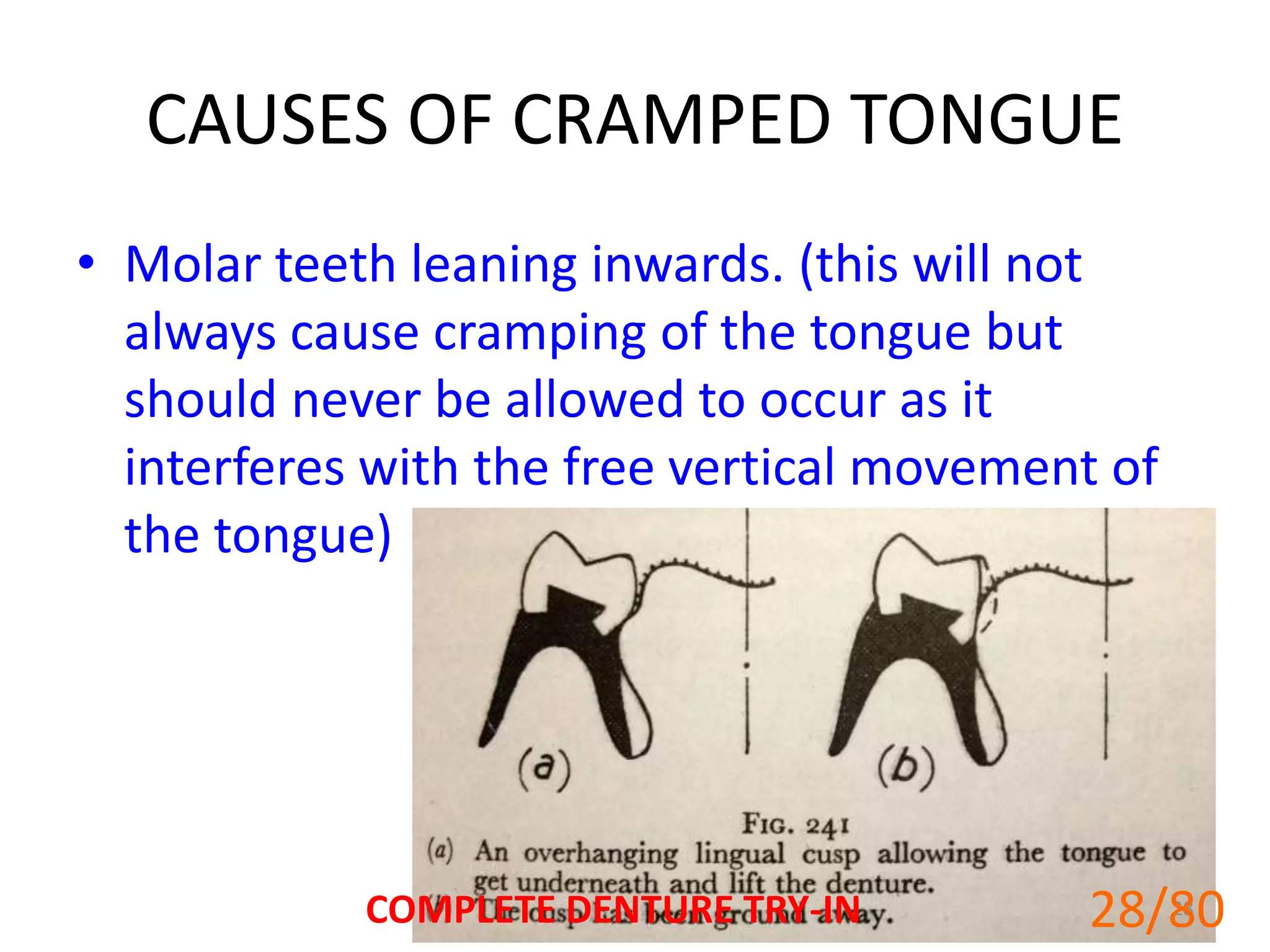 Complete Denture Try In | PPTX