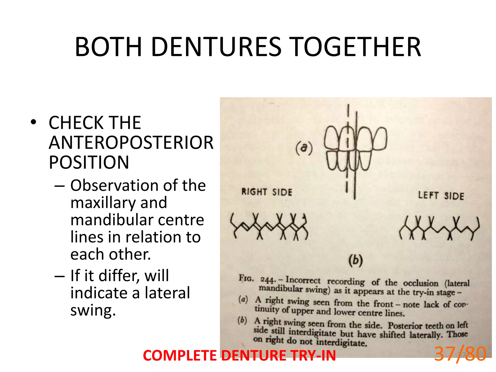 Complete Denture Try In | PPTX