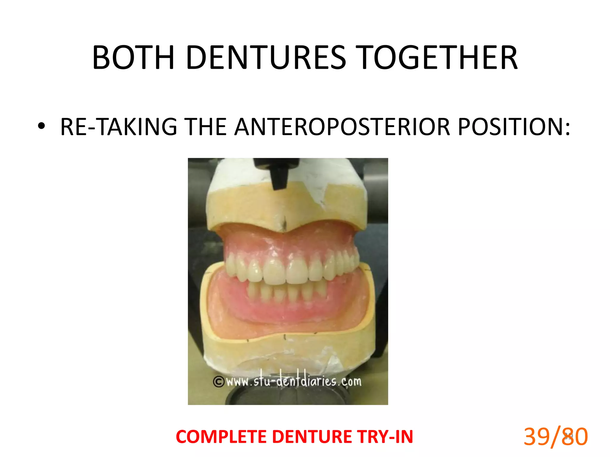 Complete Denture Try In | PPTX
