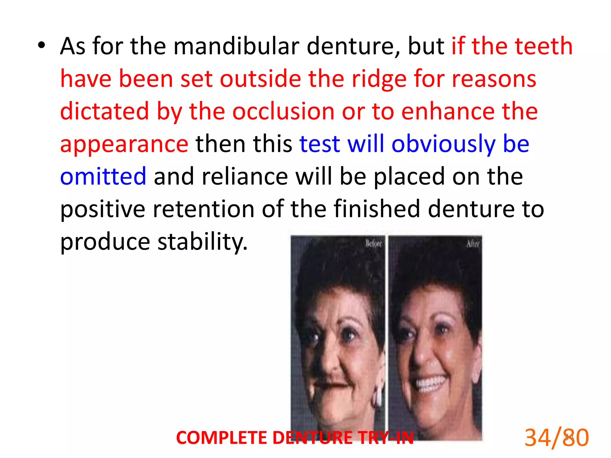 Complete Denture Try In