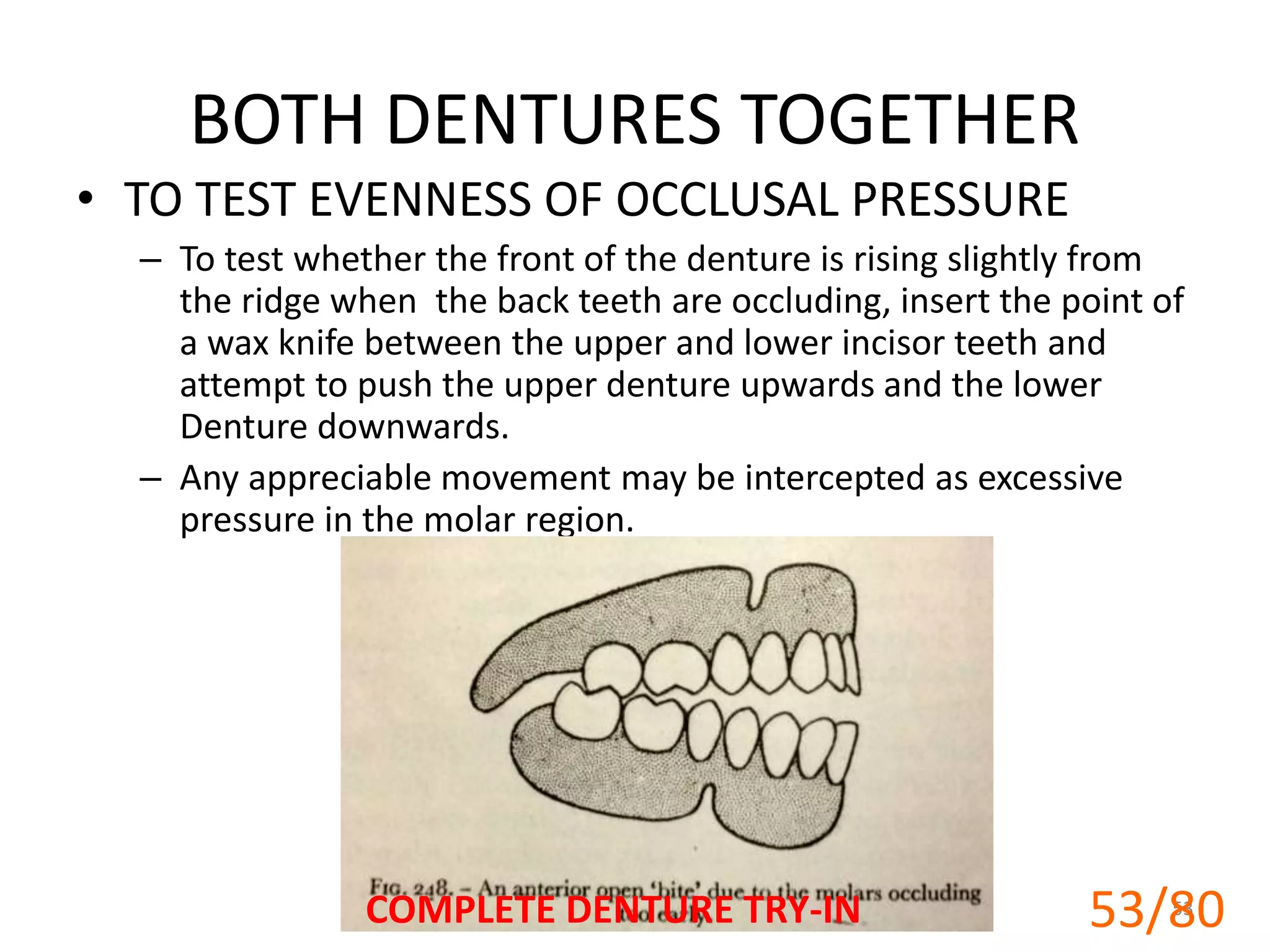 Complete Denture Try In