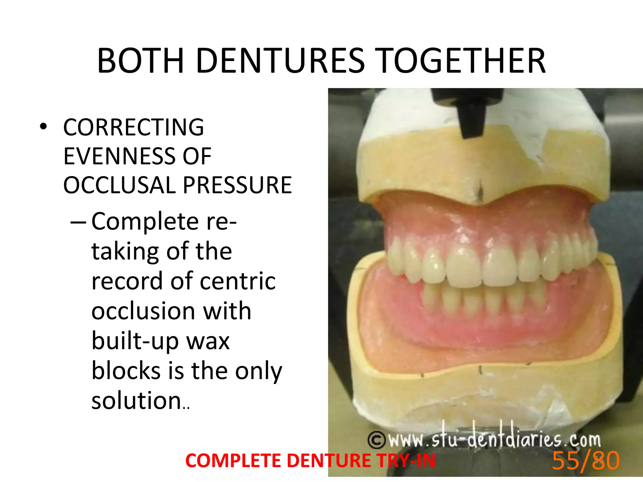 Complete Denture Try In