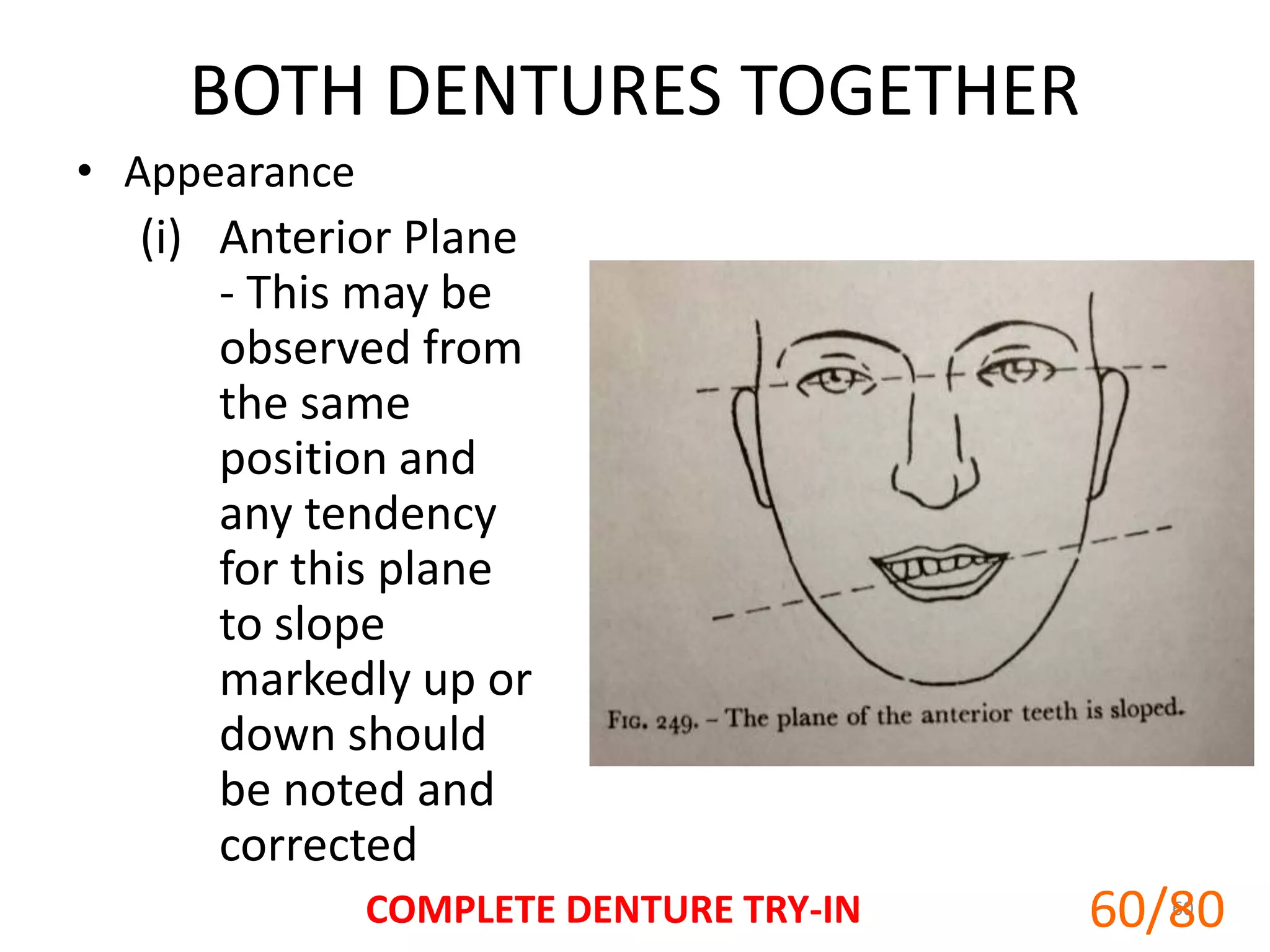Complete Denture Try In
