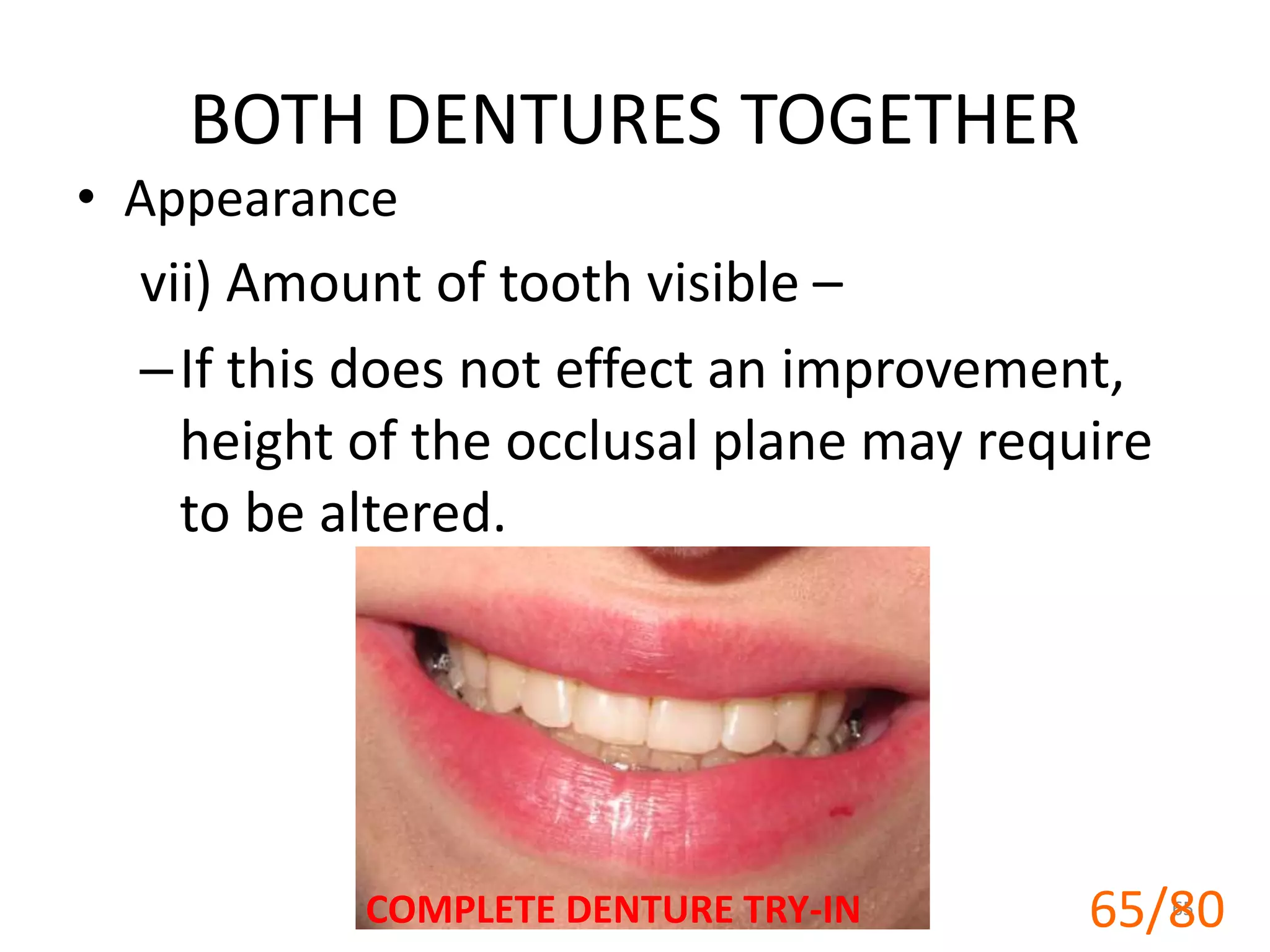 Complete Denture Try In