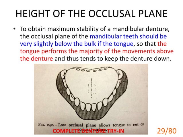 Complete Denture Try In | PPTX