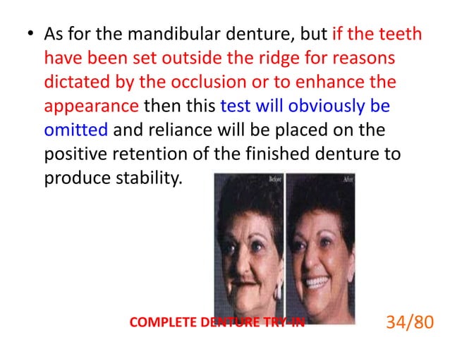 Complete Denture Try In | PPTX