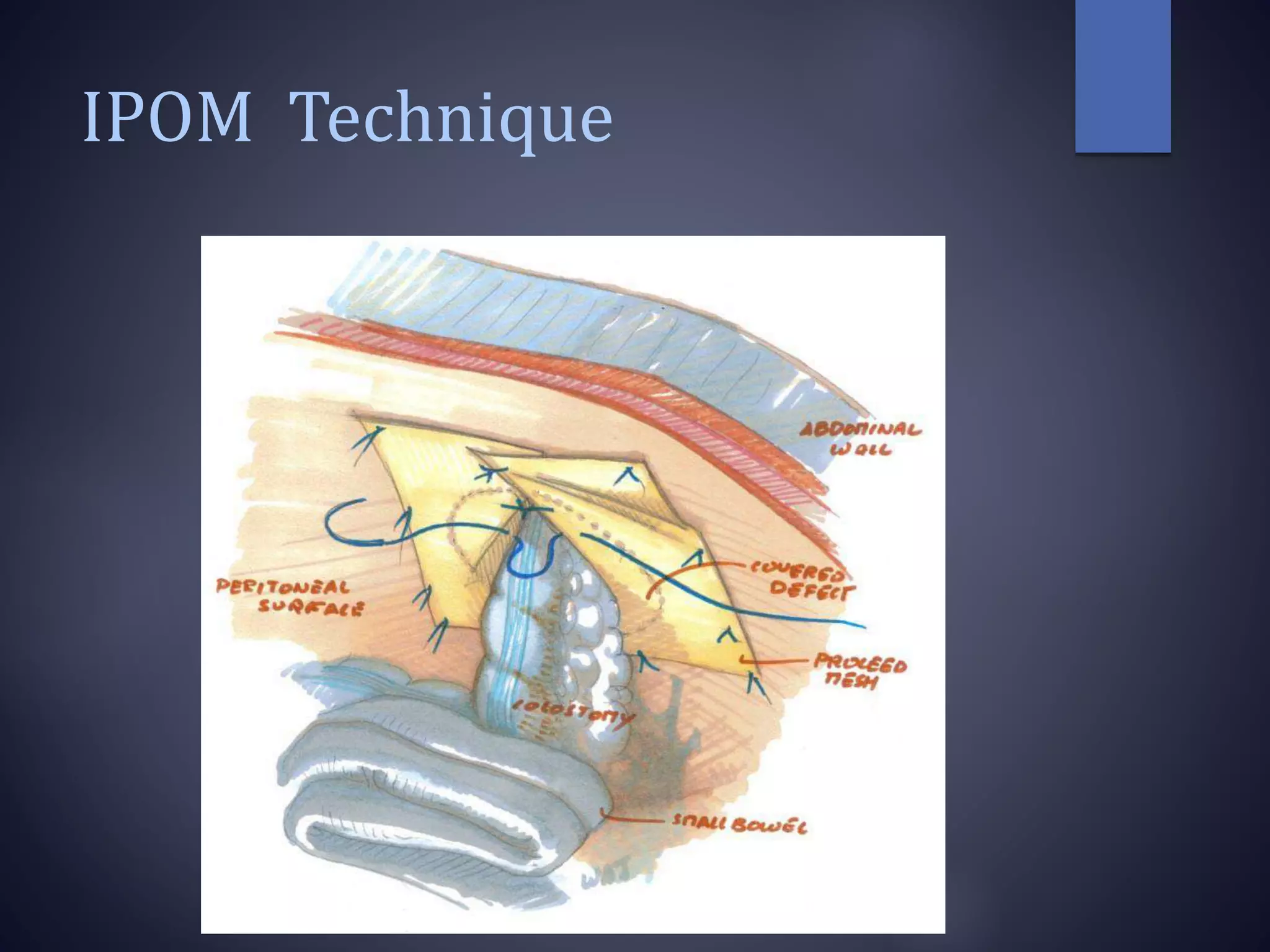 Stoma complications & its management | PPTX
