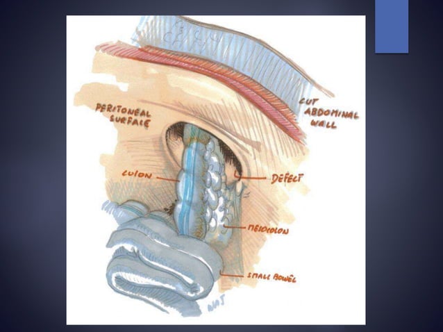 Stoma complications & its management | PPTX