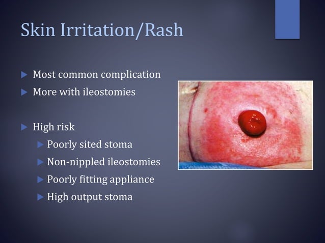 Stoma complications & its management | PPTX